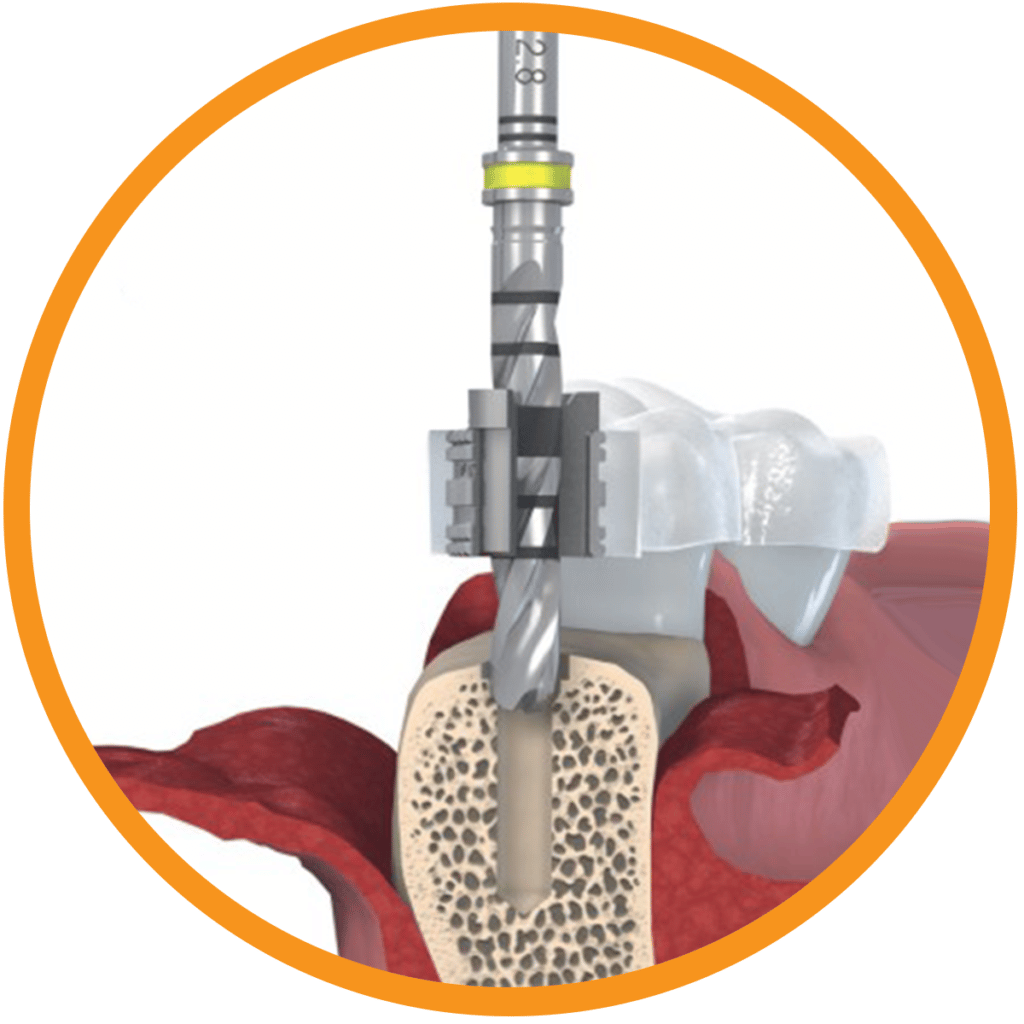 Accuguide - surgical guide for dental implant placement